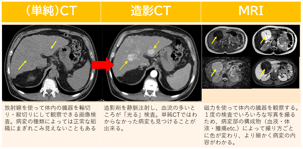 肝血管腫 Hemangioma ＋膵管内乳頭粘液性腫瘍(IPMN)｜新大阪画像の森診断クリニック｜大阪の画像診断専門クリニック