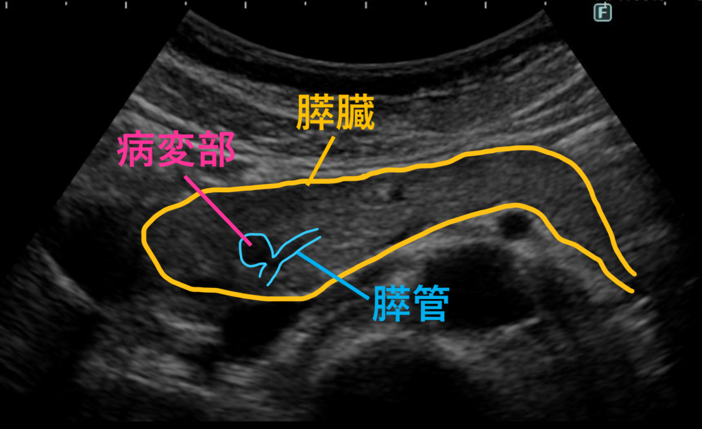 肝血管腫 Hemangioma ＋膵管内乳頭粘液性腫瘍(IPMN)｜新大阪画像の森診断クリニック｜大阪の画像診断専門クリニック