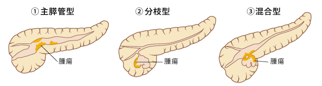肝血管腫 Hemangioma ＋膵管内乳頭粘液性腫瘍(IPMN)｜新大阪画像の森診断クリニック｜大阪の画像診断専門クリニック