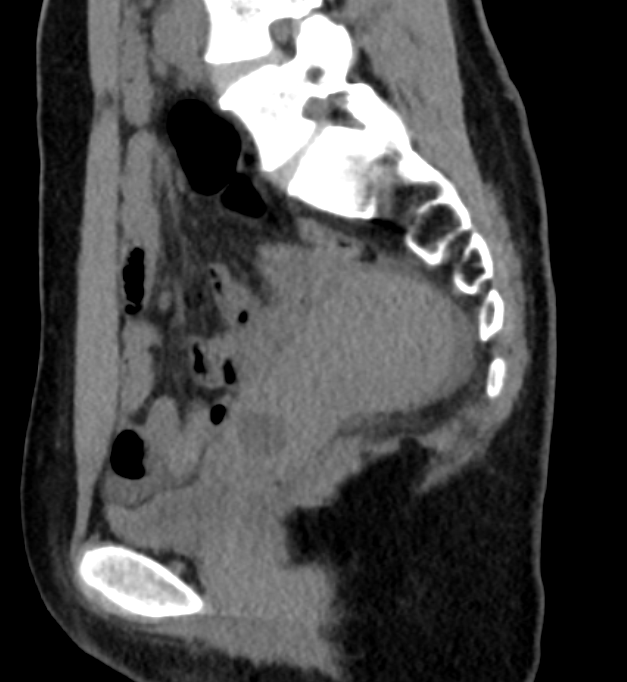LEGH (分葉状頸管腺過形成)｜新大阪画像の森診断クリニック｜大阪の画像診断専門クリニック