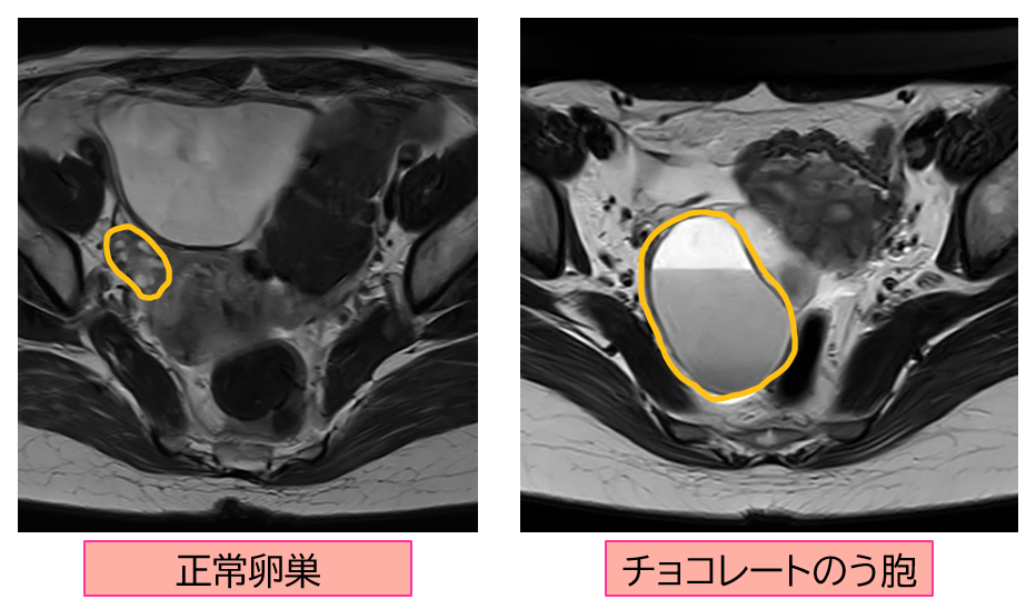 チョコレート嚢胞 Endometrioma｜新大阪画像の森診断クリニック｜大阪の画像診断専門クリニック