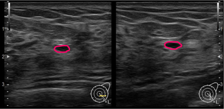 乳腺のう胞(嚢胞)＆線維腺腫 breast cyst & fibroadenoma｜新大阪画像の森診断クリニック｜大阪の画像診断専門クリニック